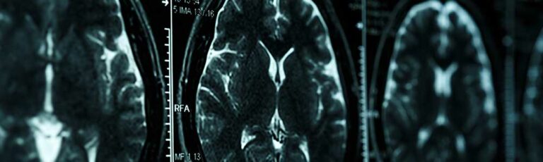 MRI in Multiple Sclerosis Guidelines Update: North America, Europe ...